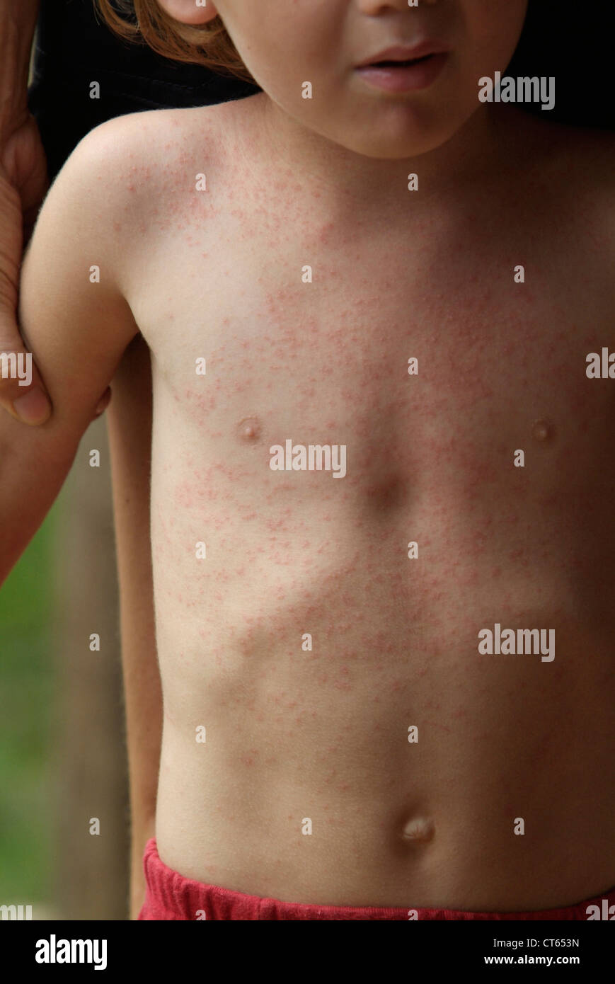 Urticarias High Resolution Stock Photography and Images - Alamy