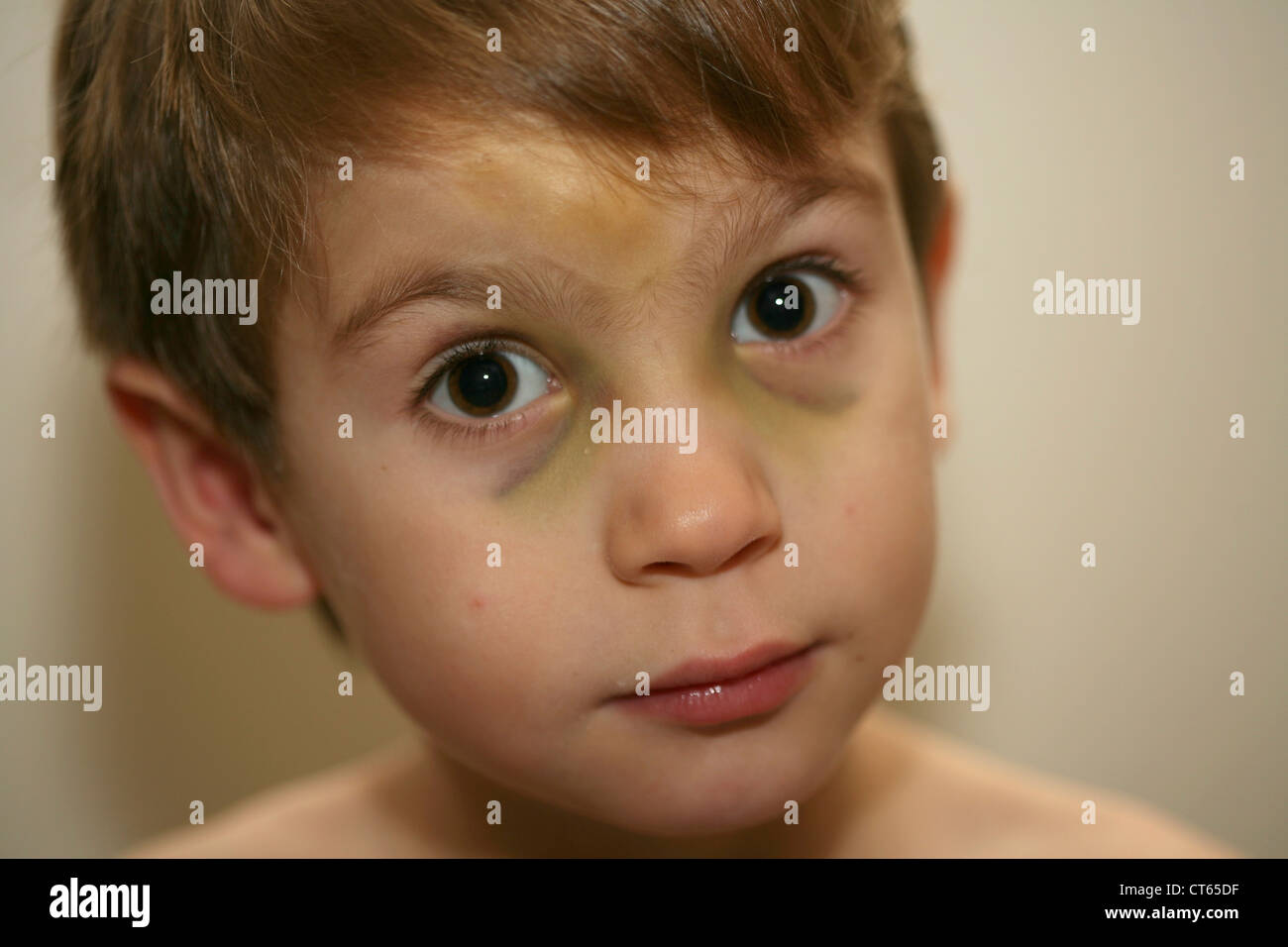 Traumatic Hematoma High Resolution Stock Photography and Images - Alamy