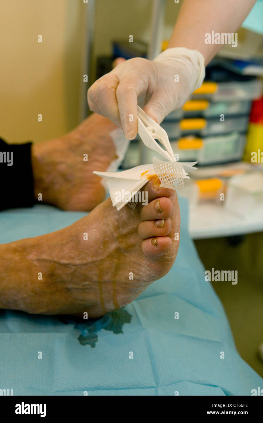 Amputated toe hi-res stock photography and images - Alamy