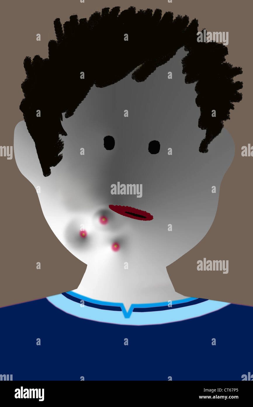 Acne illustration hi-res stock photography and images - Alamy