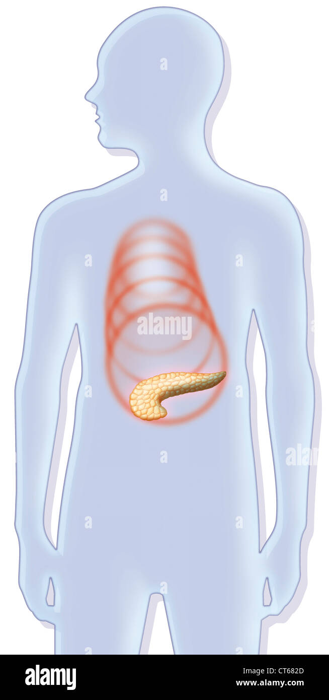 Pancreas acute pancreatitis hi-res stock photography and images - Alamy