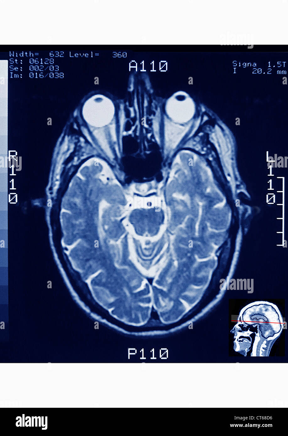 Normal Brain Mri High Resolution Stock Photography and Images - Alamy