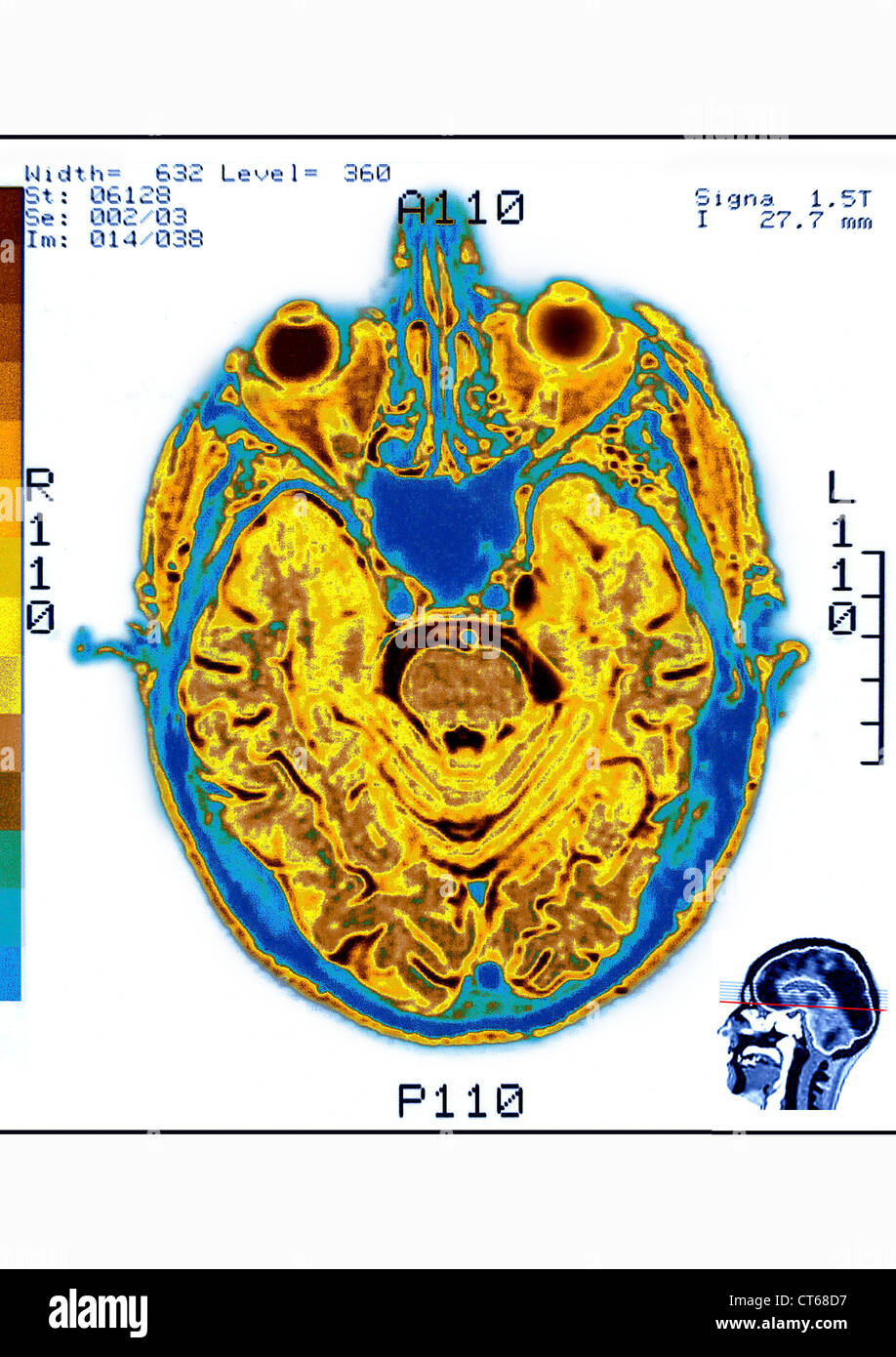 Normal Brain Mri High Resolution Stock Photography and Images - Alamy