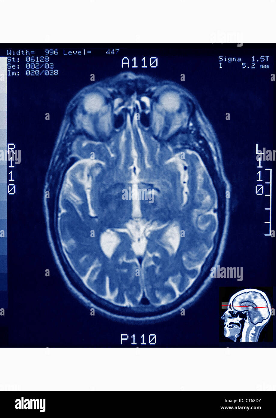 Normal brain mri hi-res stock photography and images - Alamy
