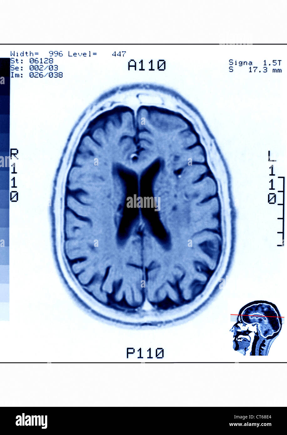 Cingulate gyrus hi-res stock photography and images - Alamy