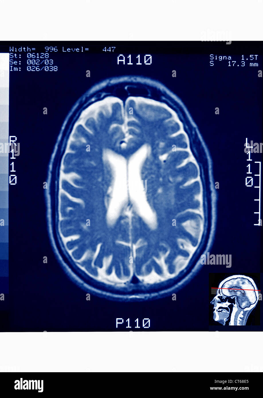Cingulate gyrus hi-res stock photography and images - Alamy