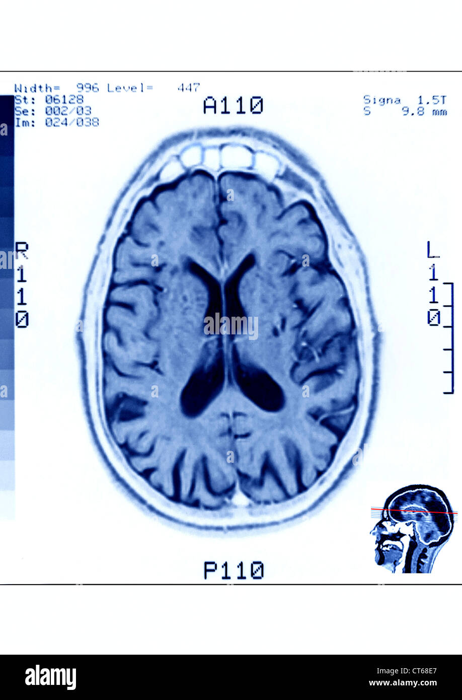 Corpus callosum mri hi-res stock photography and images - Alamy