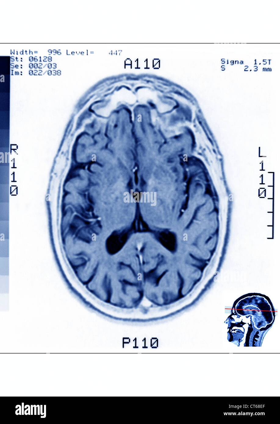 Normal Brain Mri High Resolution Stock Photography and Images - Alamy