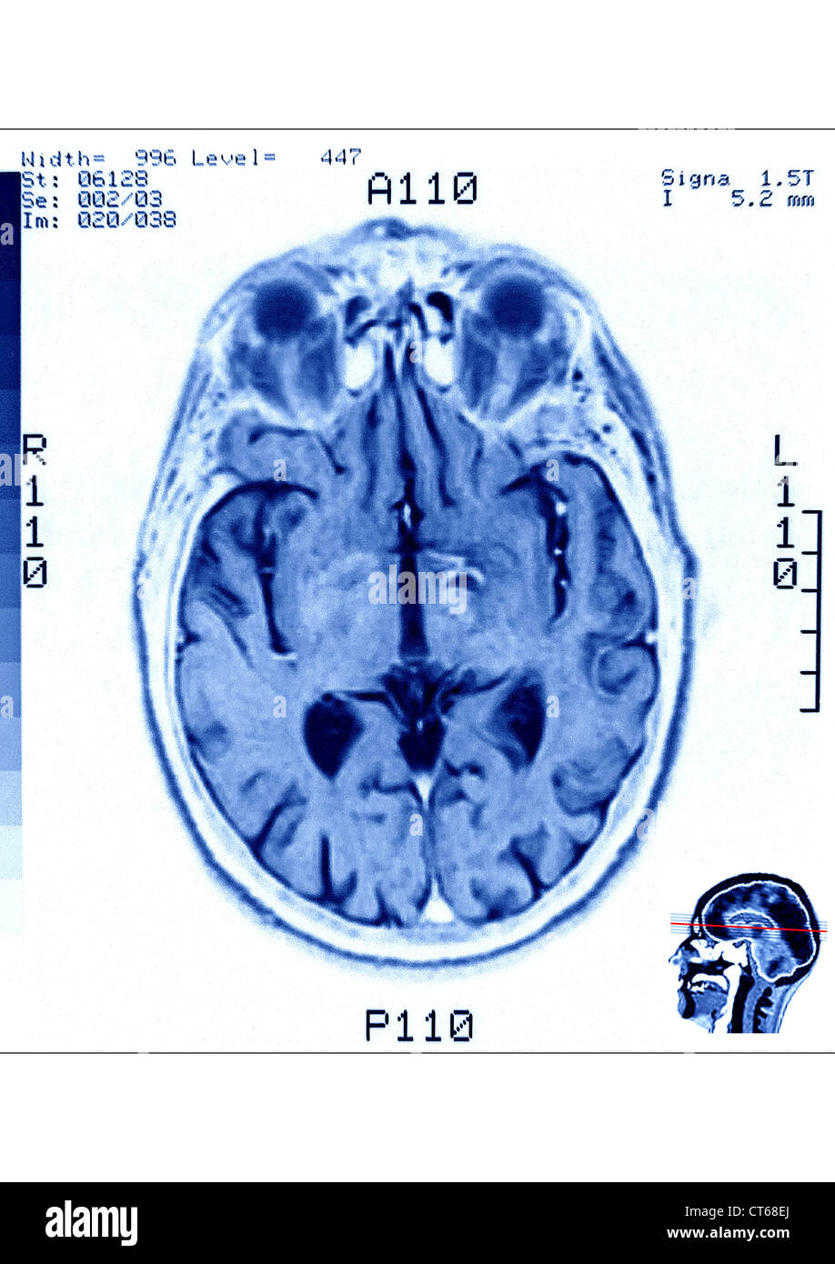 Normal brain mri hi-res stock photography and images - Alamy