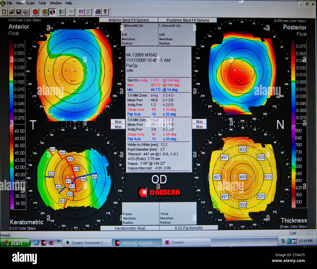 Corneal topography hi-res stock photography and images - Alamy