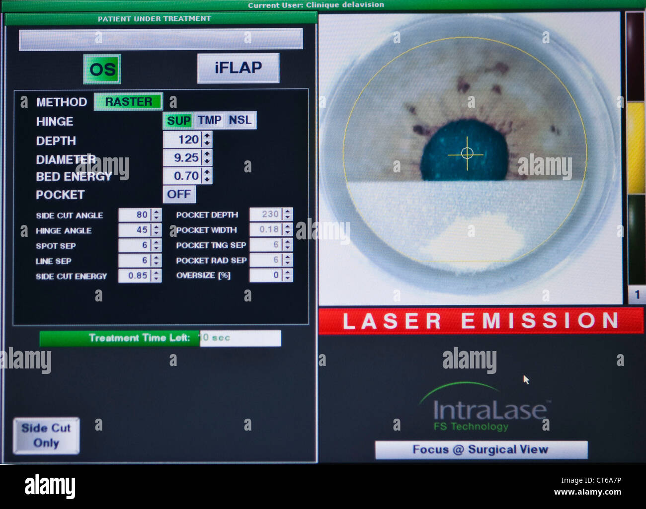 Laser in situ keratomileusis hi-res stock photography and images - Alamy