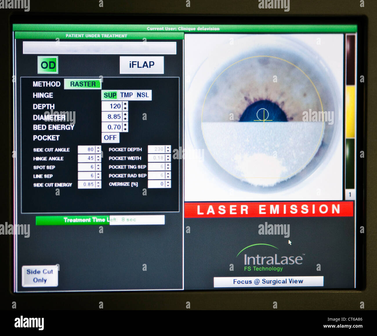 EYE LASER SURGERY Stock Photo - Alamy