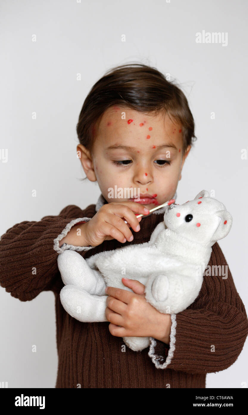 Face chicken pox hi-res stock photography and images - Alamy