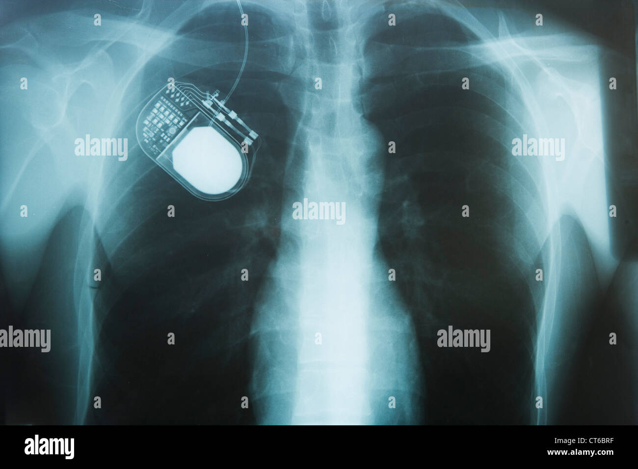 NERVE STIMULATOR, X-RAY Stock Photo - Alamy