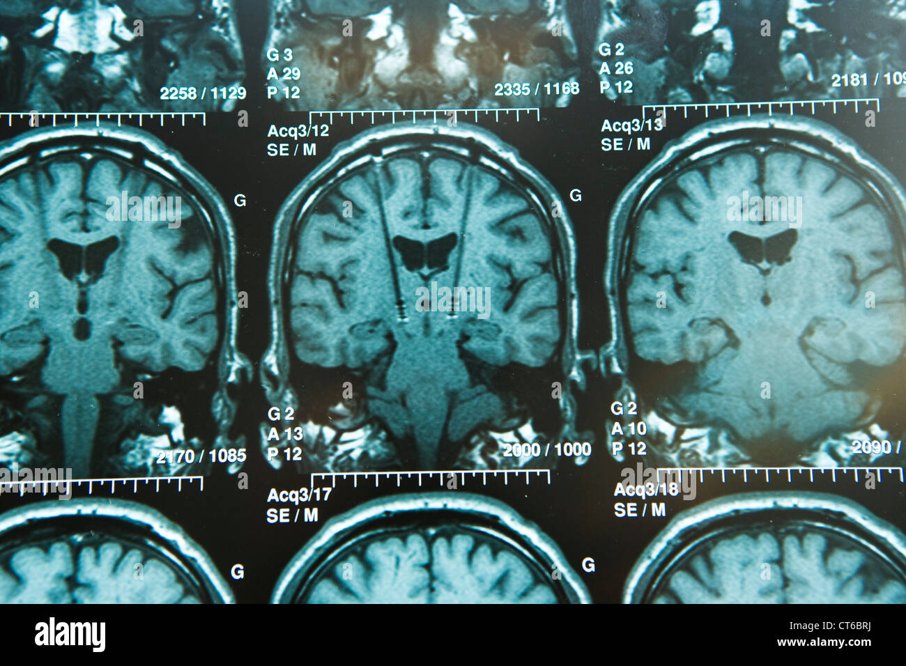 BRAIN ELECTROSTIMULATION, NMR Stock Photo - Alamy