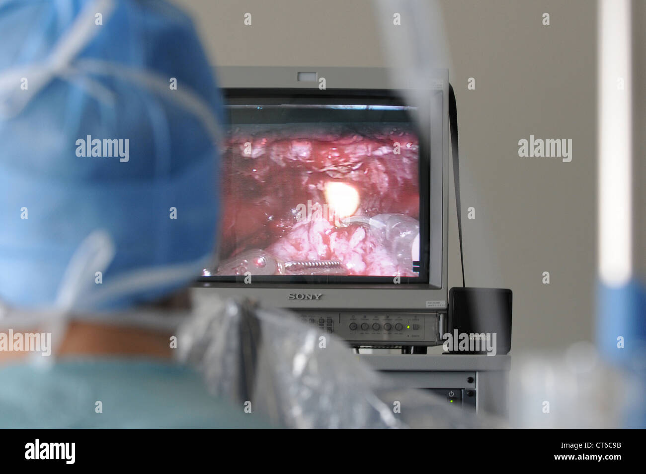 Prostate gland removal hi-res stock photography and images - Alamy