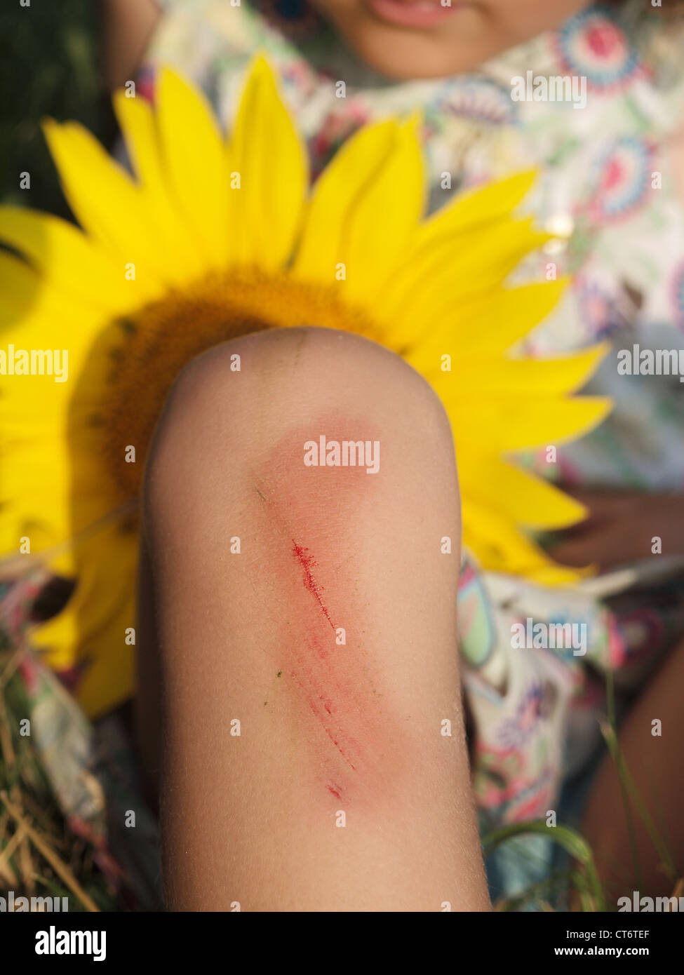 Grazed injury hi-res stock photography and images - Alamy