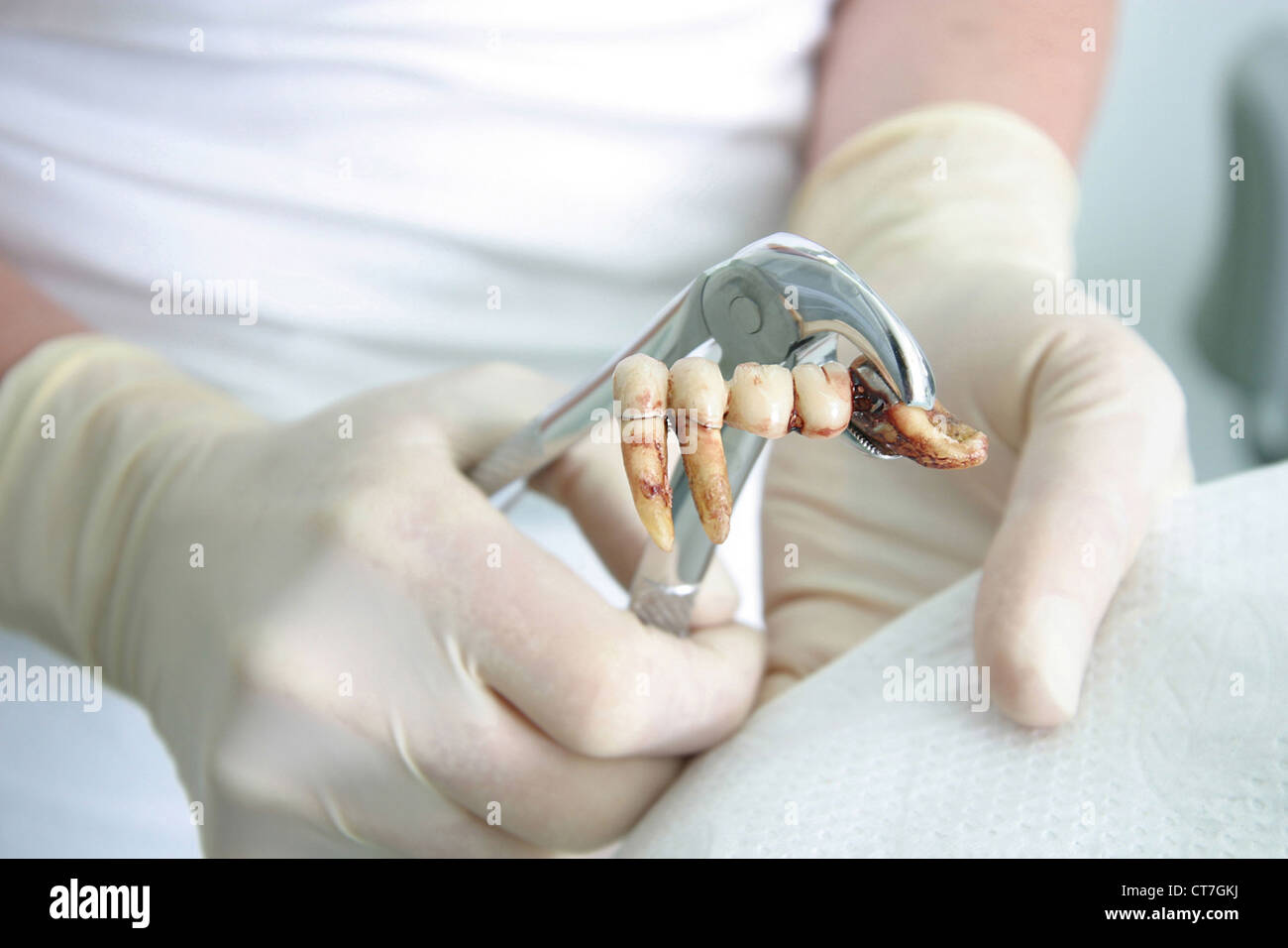 Forceps with tooth root Stock Photo - Alamy