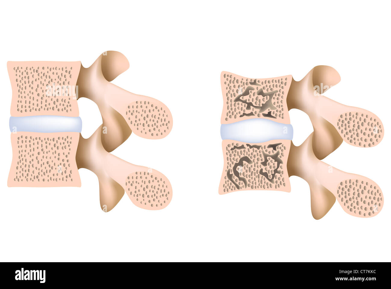 Lumbar spine osteoporosis Stock Photo - Alamy