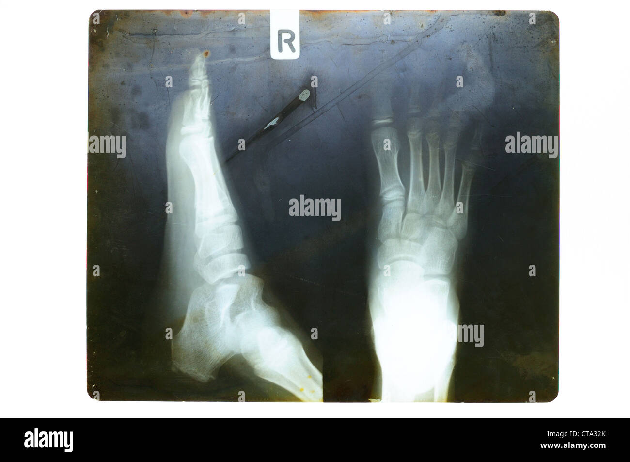 Right foot x ray hi-res stock photography and images - Alamy