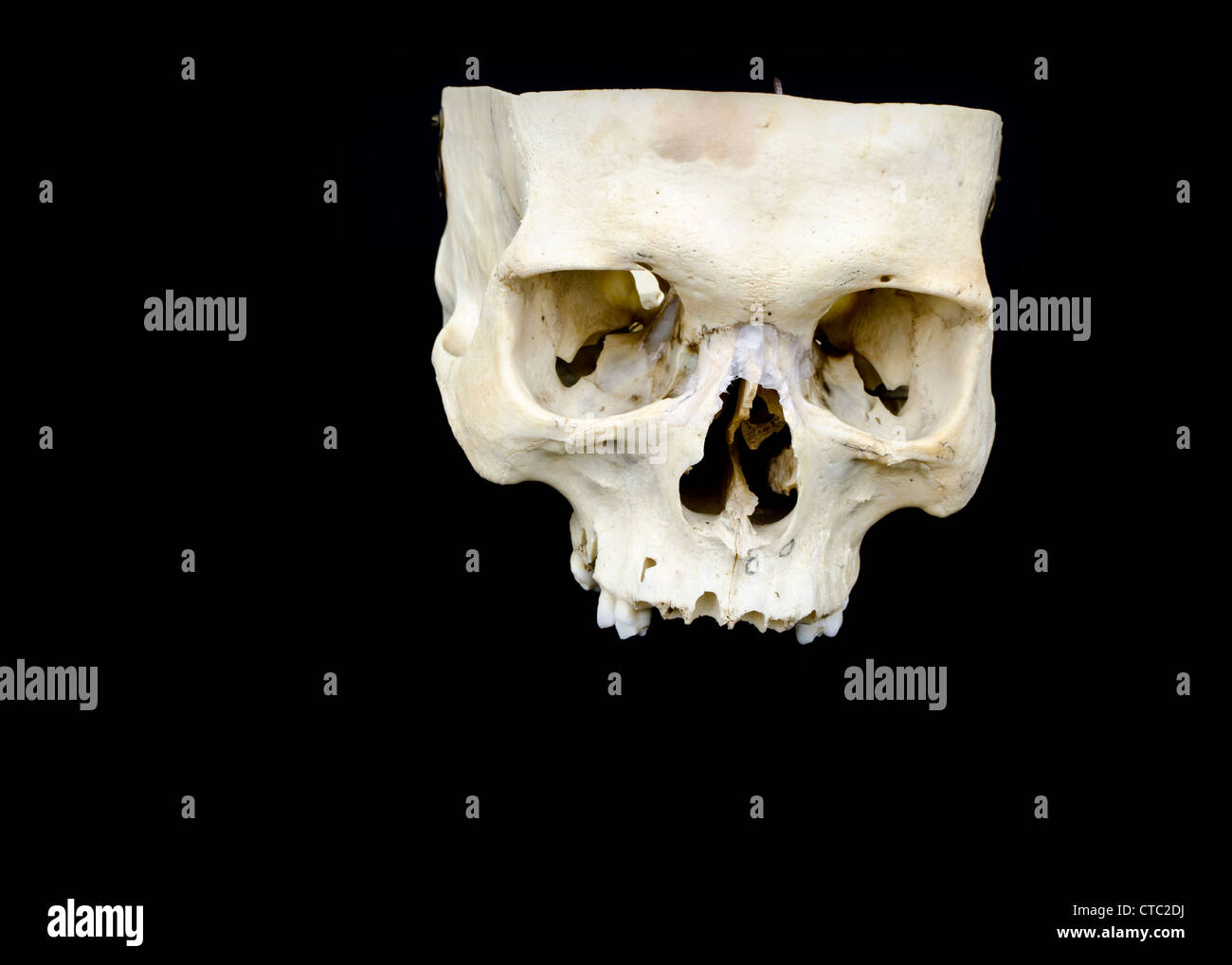 Facial Fracture High Resolution Stock Photography and Images - Alamy