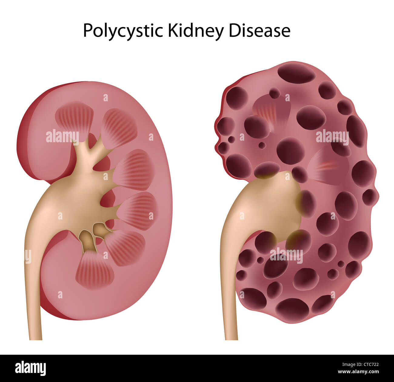 Polycystic kidney disease Stock Photo - Alamy