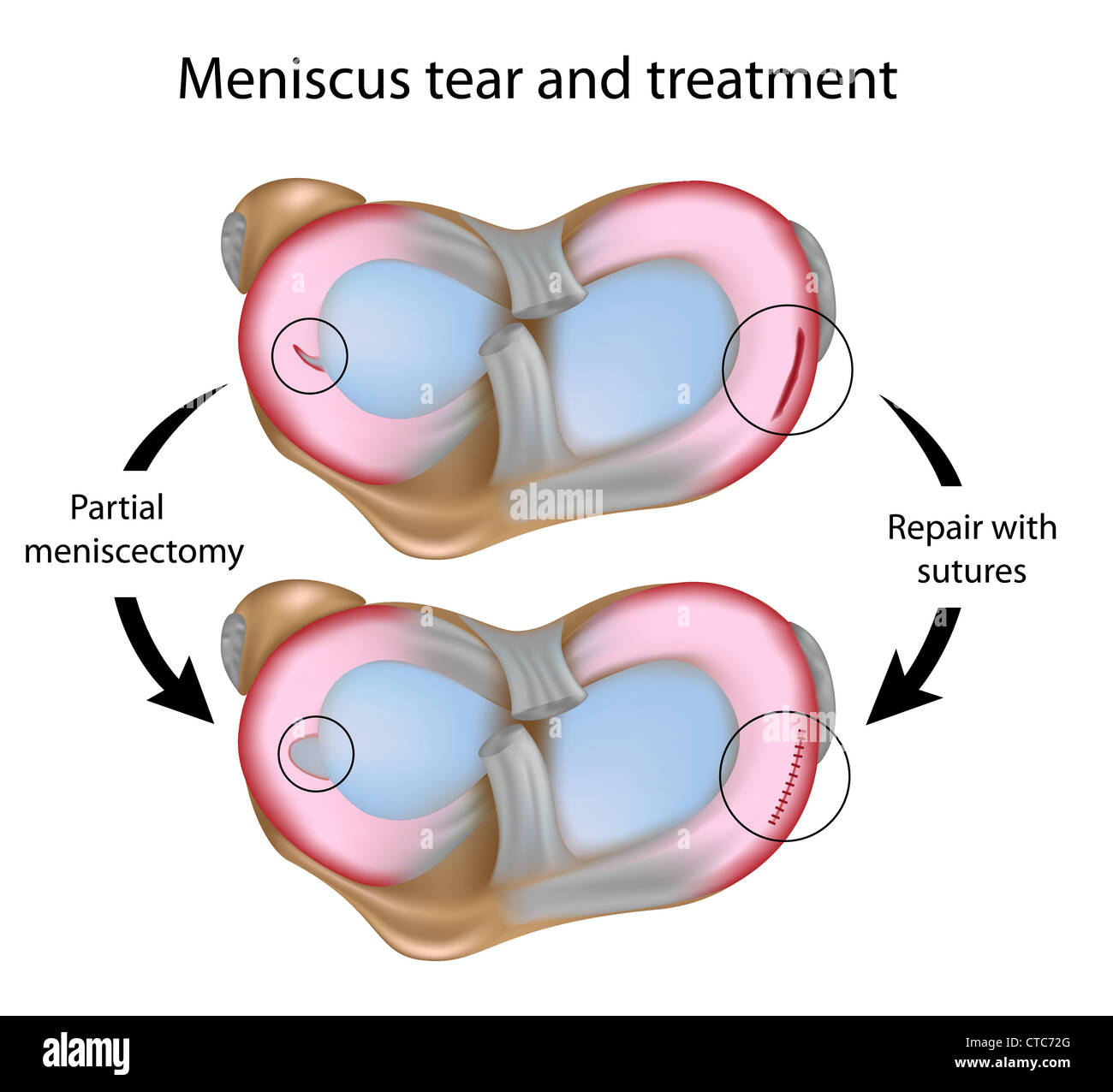 Meniscus tear and surgery Stock Photo - Alamy