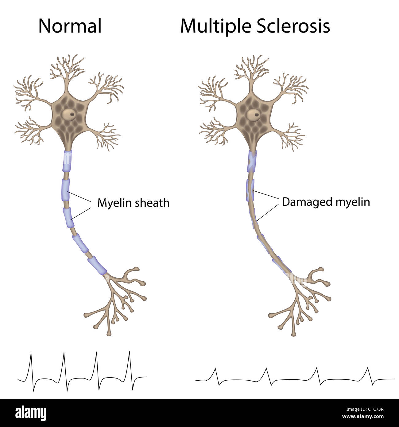Nerve cell multiple sclerosis Cut Out Stock Images & Pictures - Alamy