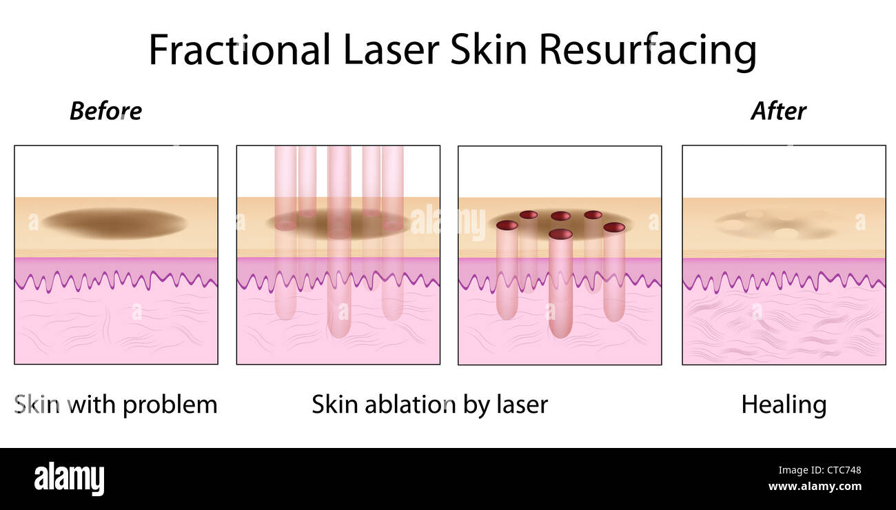 Fractional Laser Skin Resurfacing Stock Photo - Alamy