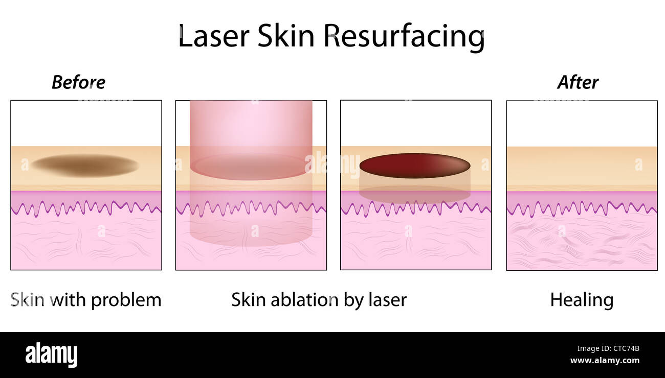 Laser Skin Resurfacing Stock Photo - Alamy