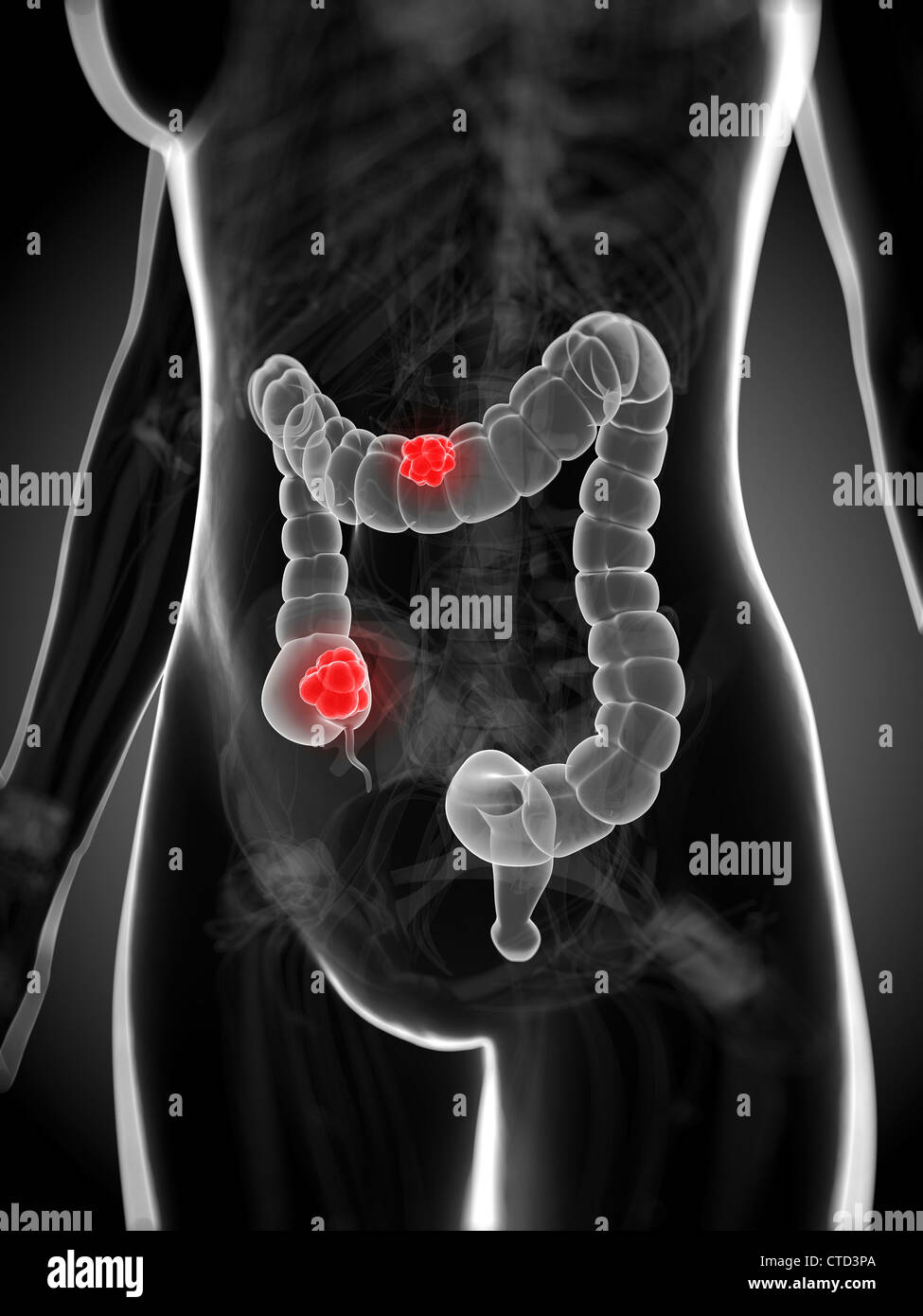 Bowel cancer artwork Stock Photo - Alamy