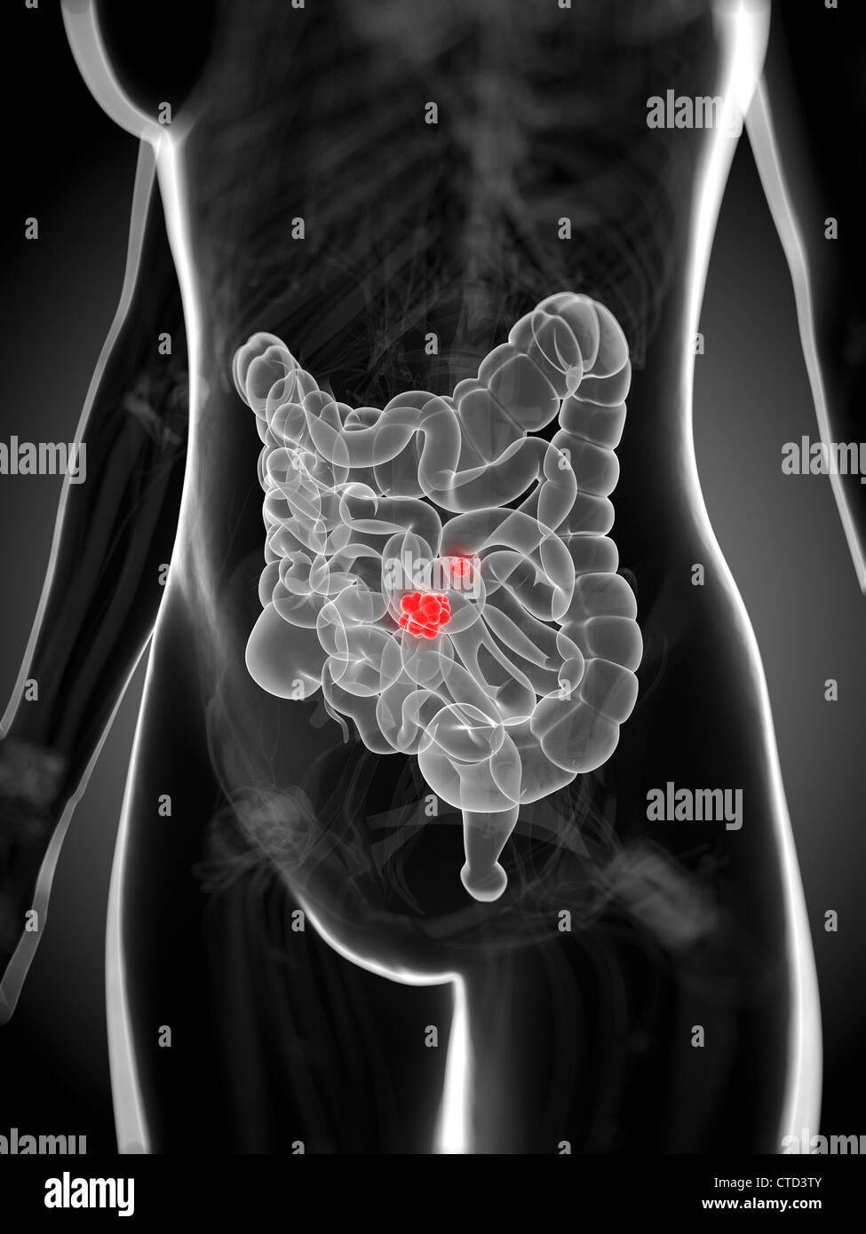 Intestinal tumors hi-res stock photography and images - Alamy