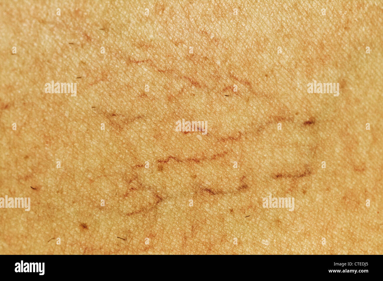Varicose veins hi-res stock photography and images - Alamy