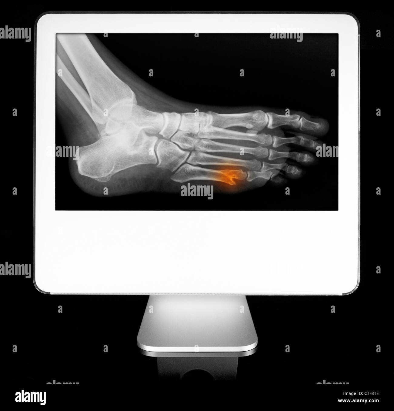 Broken toe hi-res stock photography and images - Alamy