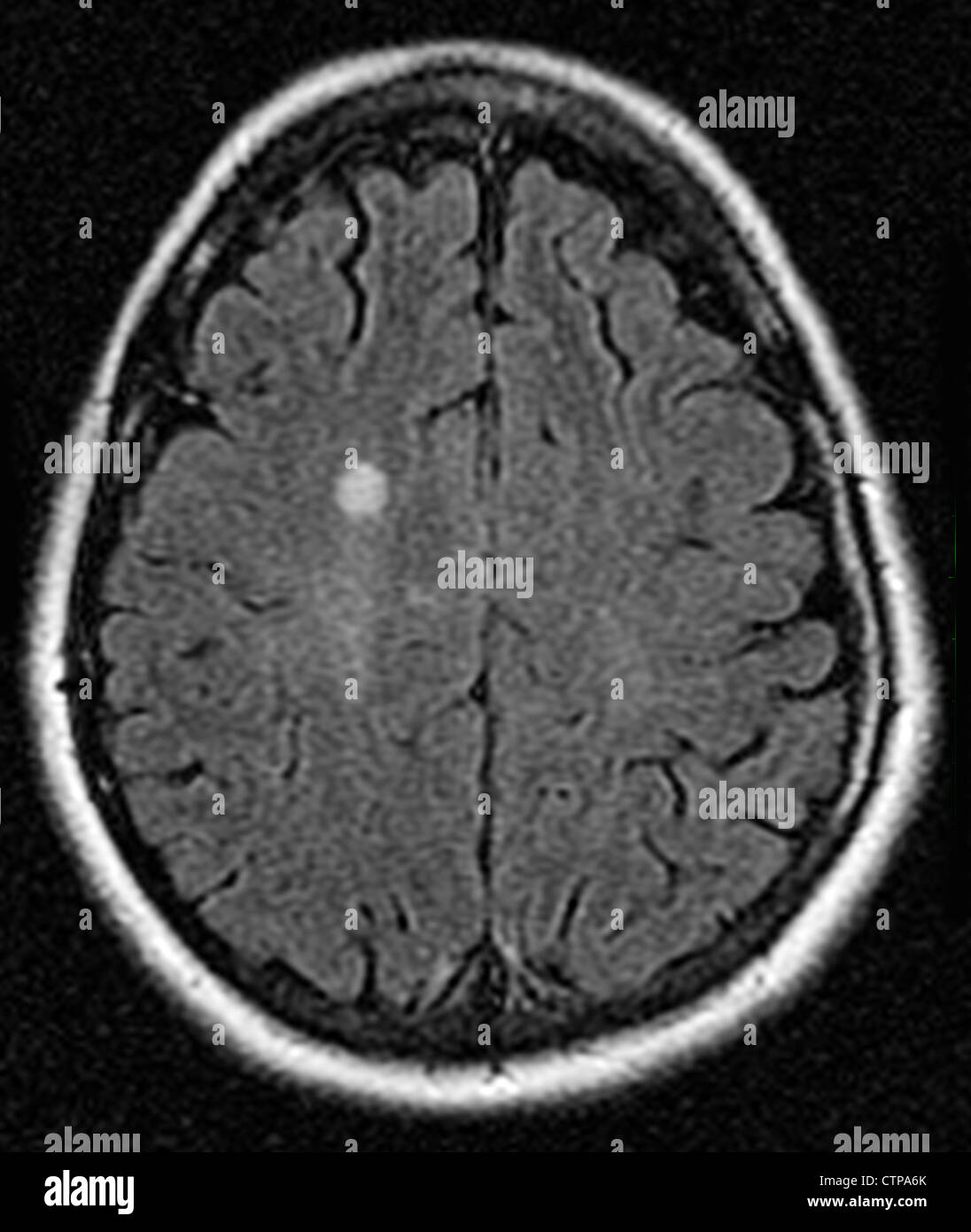 MRI showing multiple sclerosis in a 42 year old woman Stock Photo - Alamy