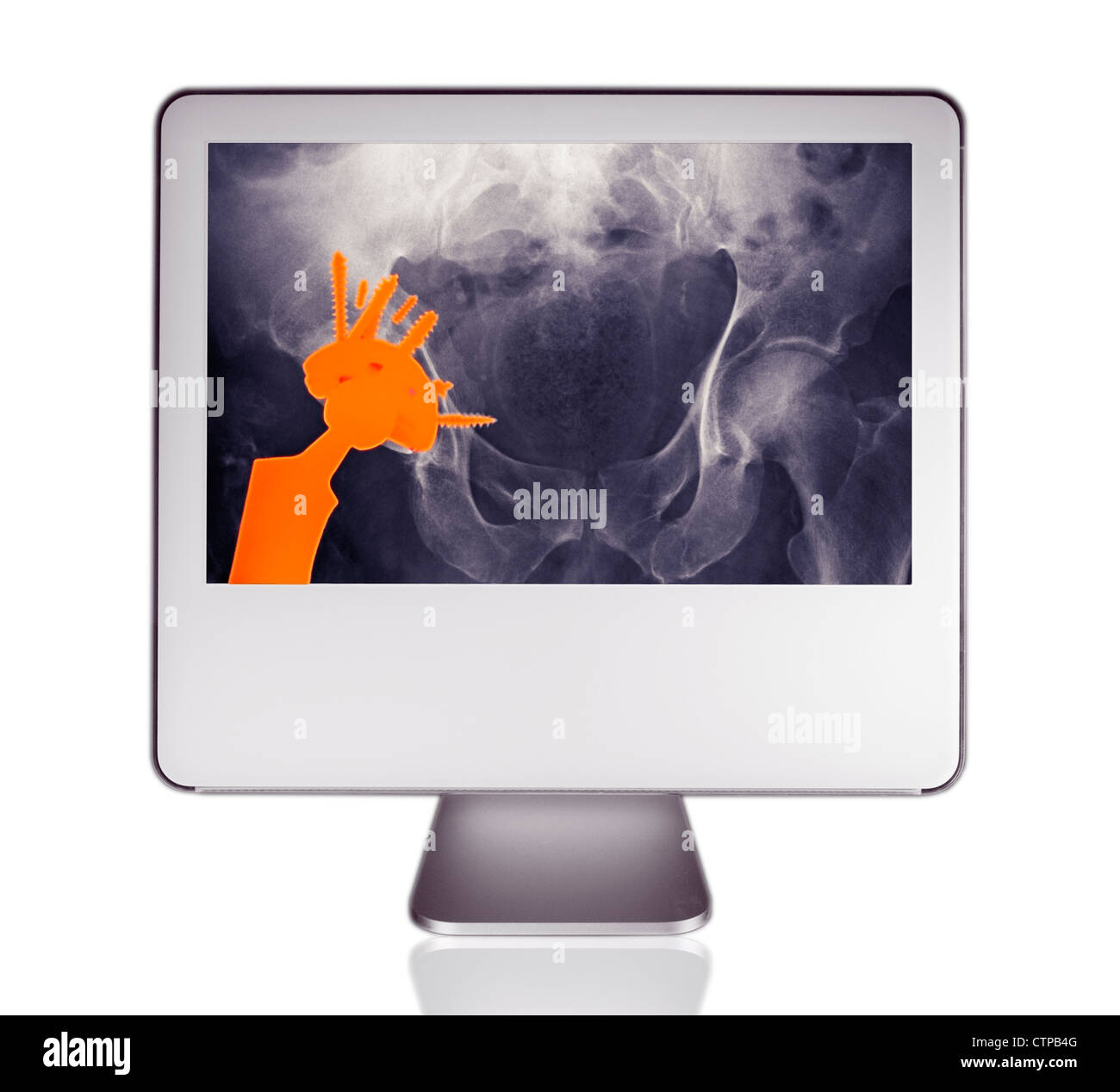 Hip replacement hi-res stock photography and images - Alamy