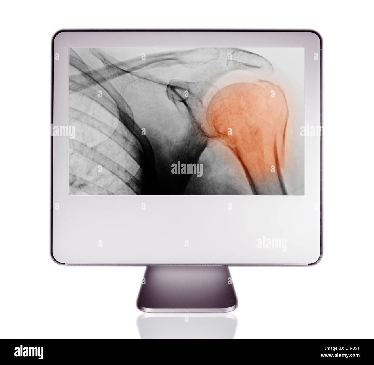 Shoulder pain and computer hi-res stock photography and images - Alamy