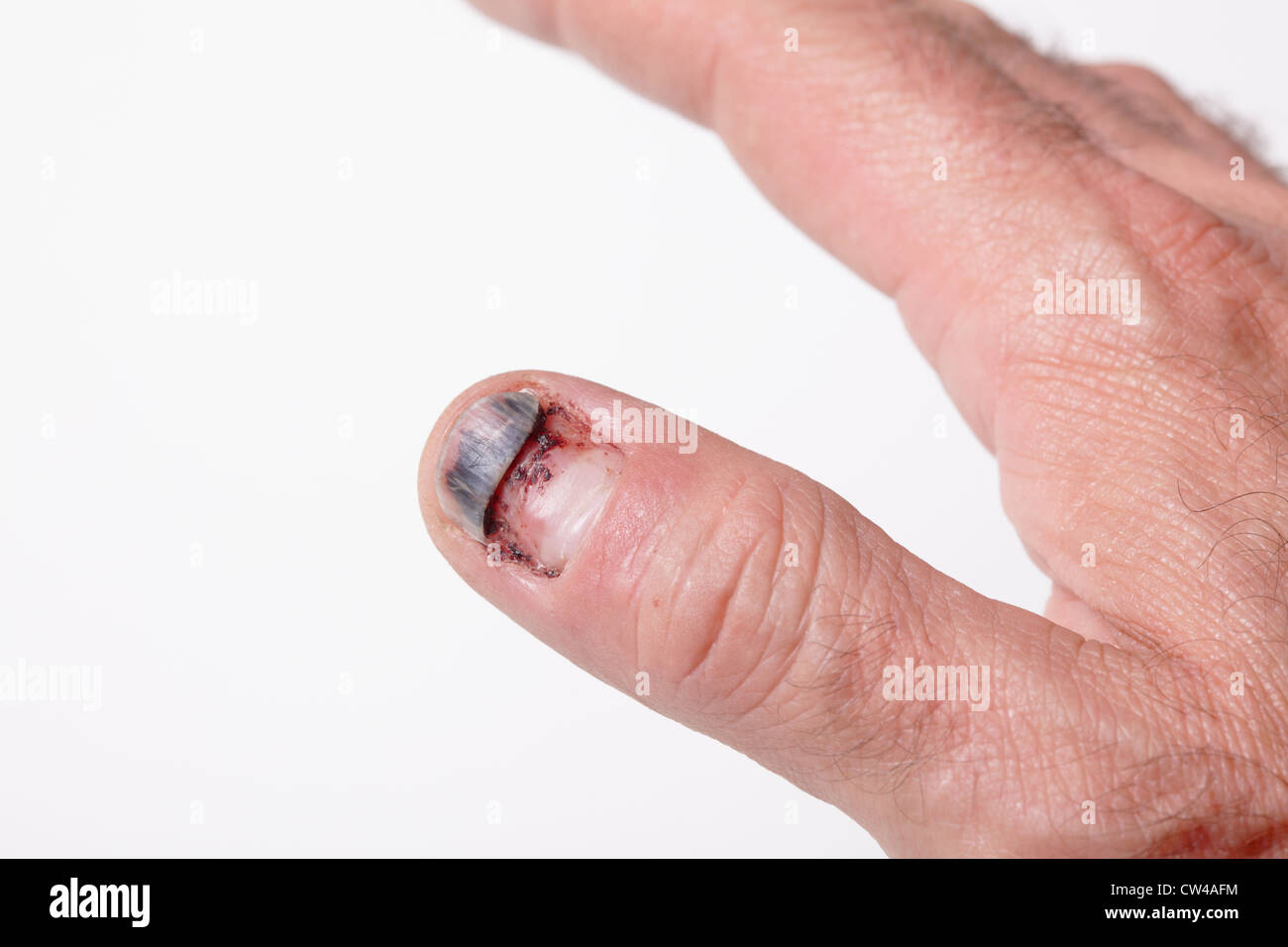 Nail injury hi-res stock photography and images - Alamy