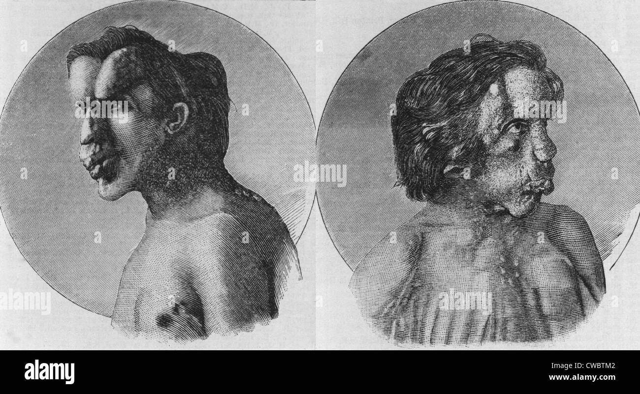 Joseph merrick hi-res stock photography and images - Alamy