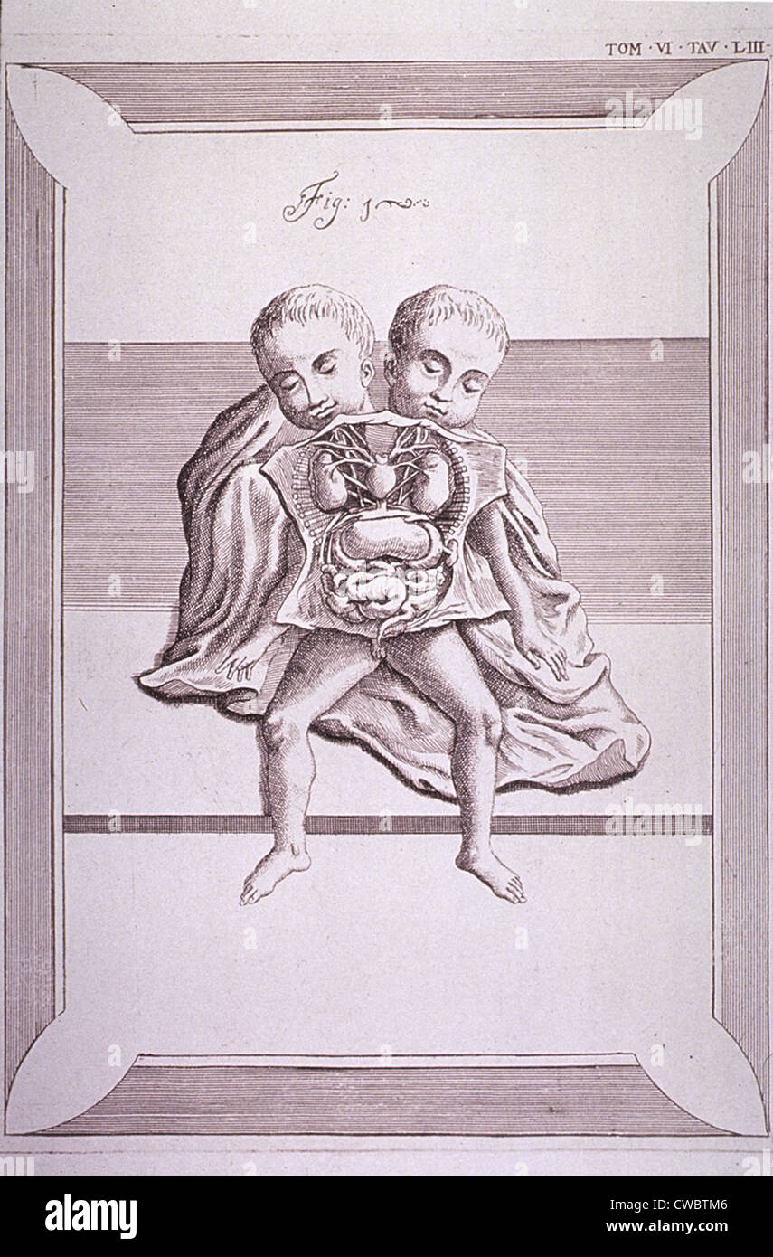 Conjoined twins with common torso and limbs, and the two heads. The ...