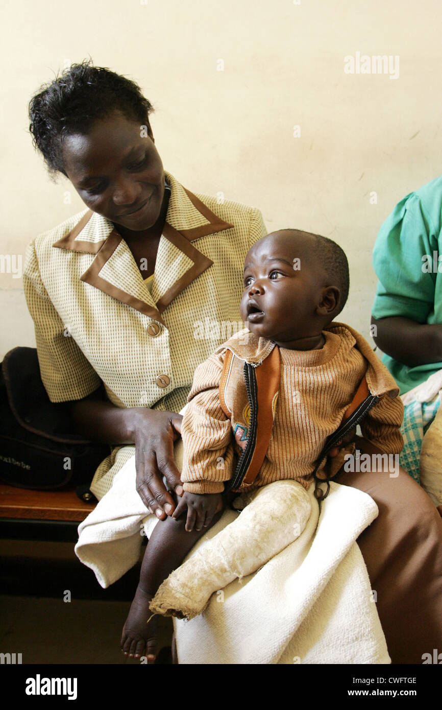 Kenya, clubfoot treatment at Moi University Hospital Stock Photo - Alamy