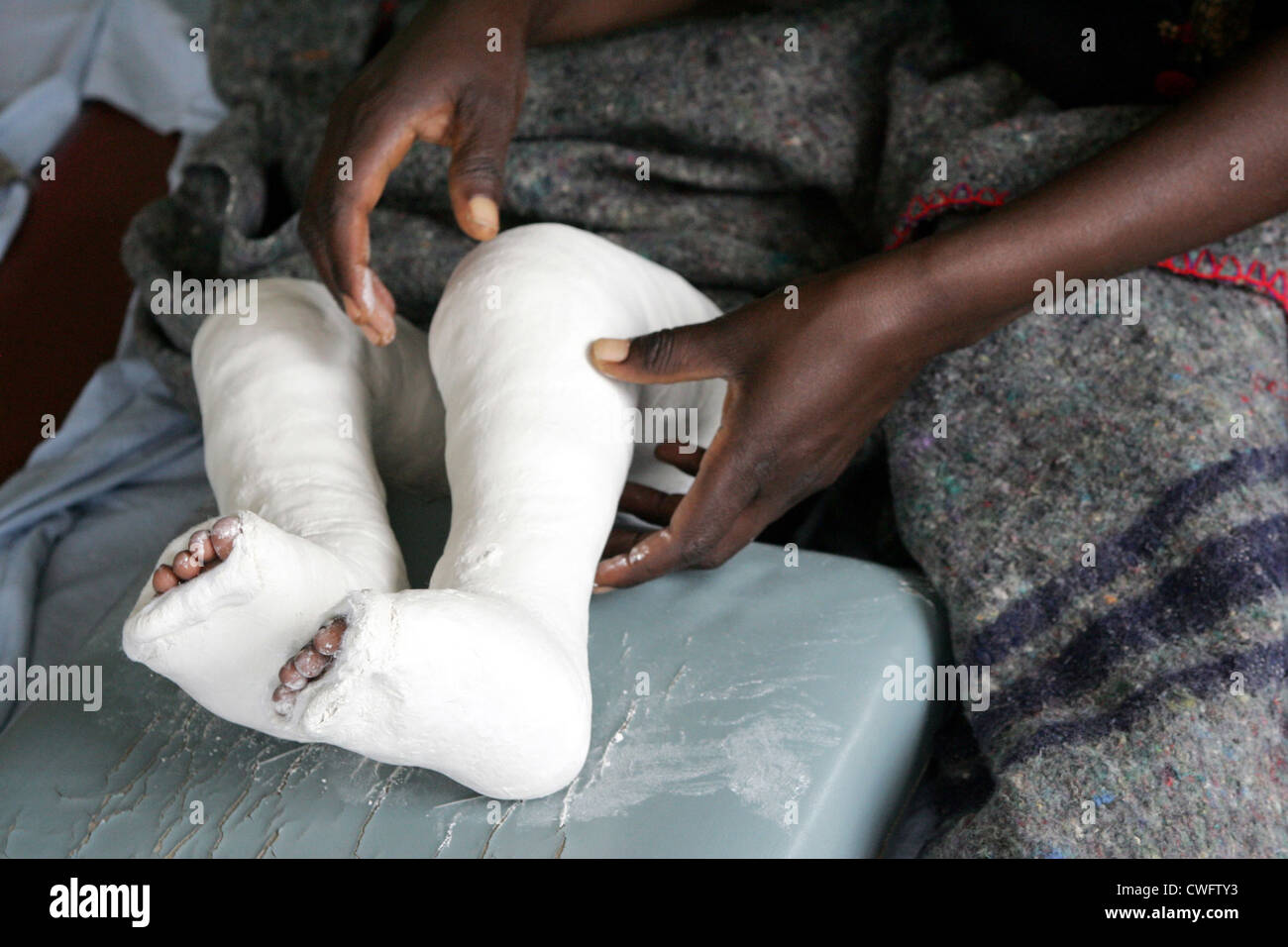 Clubfoot hi-res stock photography and images - Alamy