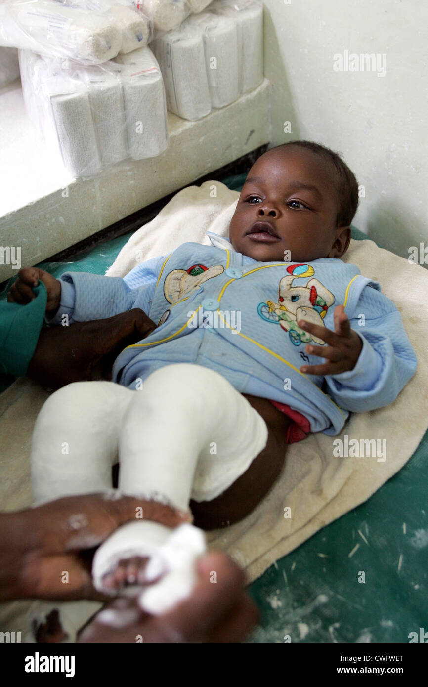 Kenya, clubfoot treatment at Moi University Hospital Stock Photo - Alamy