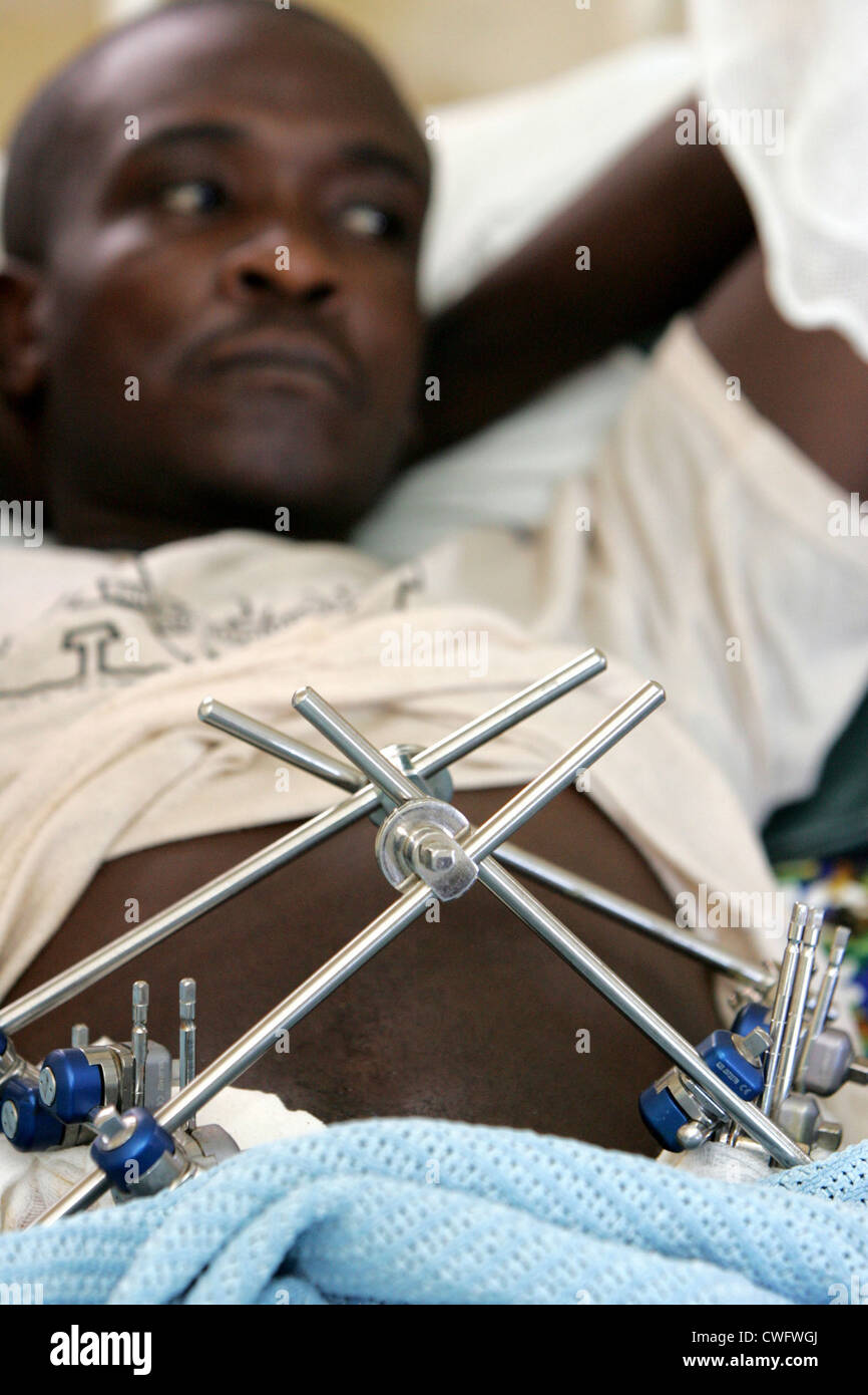 External fixator hi-res stock photography and images - Alamy