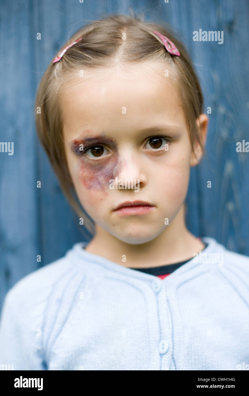 Swollen eye injury injuries hi-res stock photography and images - Alamy