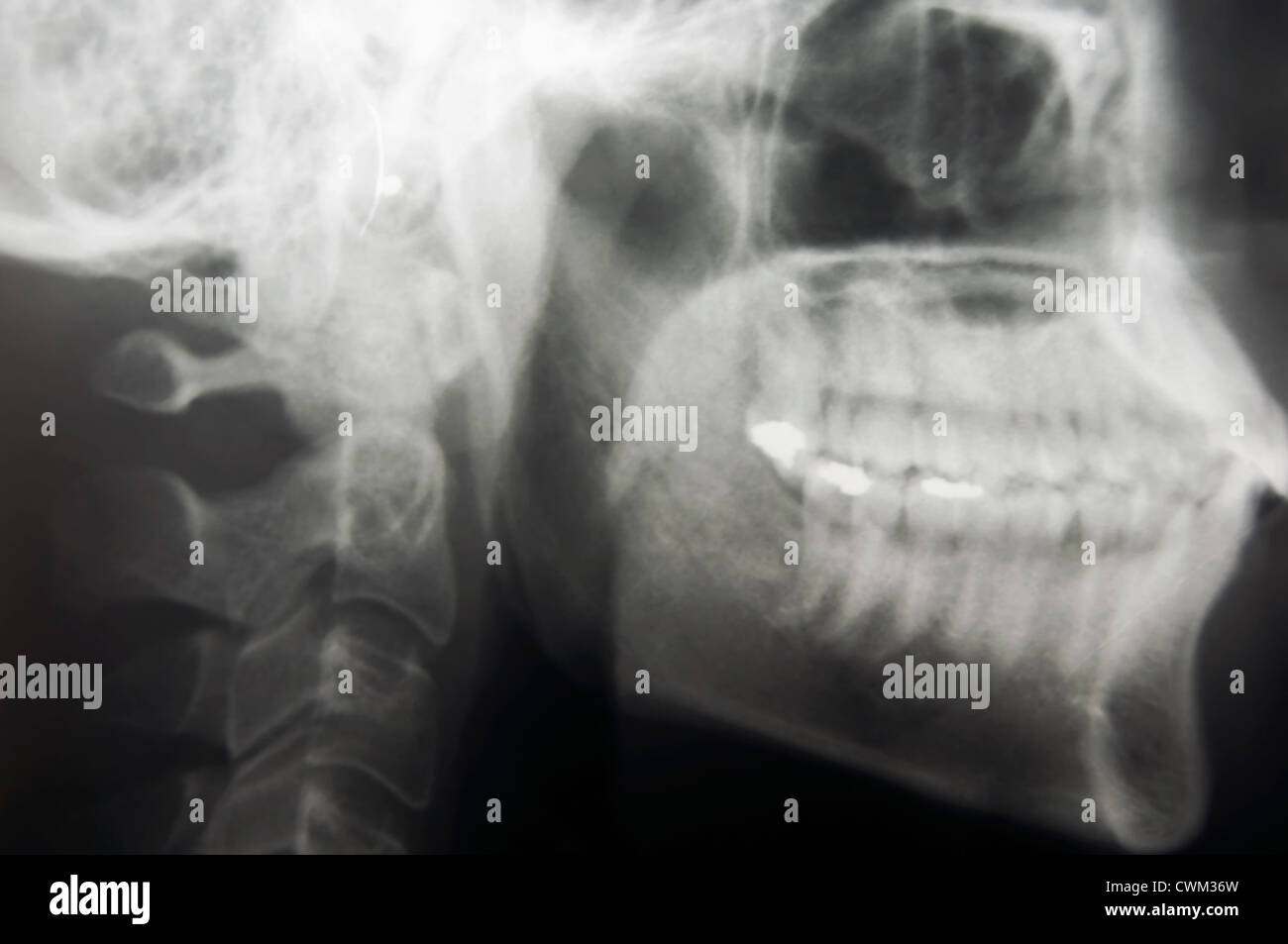 Transparent x ray hi-res stock photography and images - Alamy