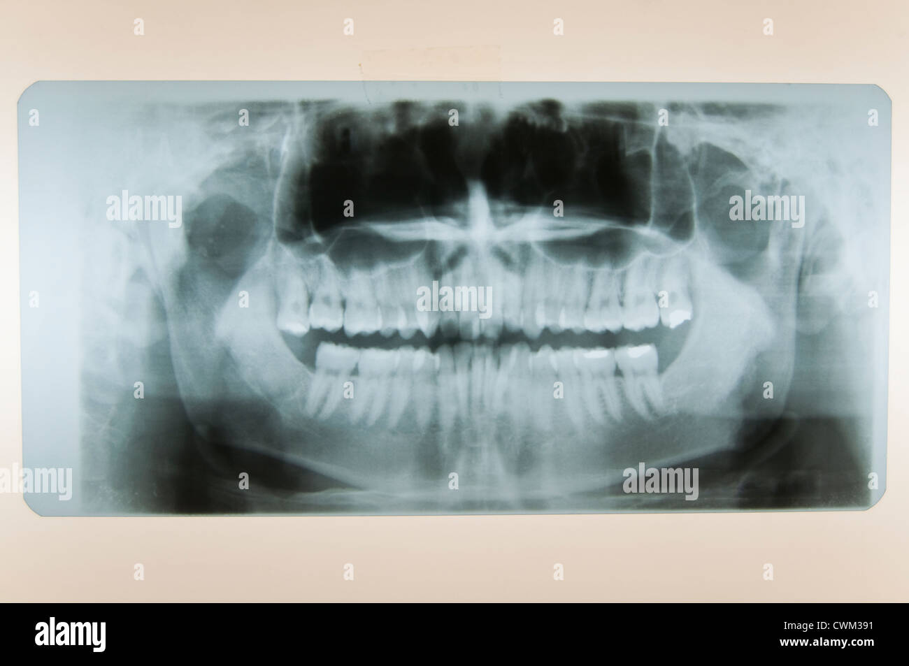 Close-up shot of dental x-ray of human teeth Stock Photo - Alamy