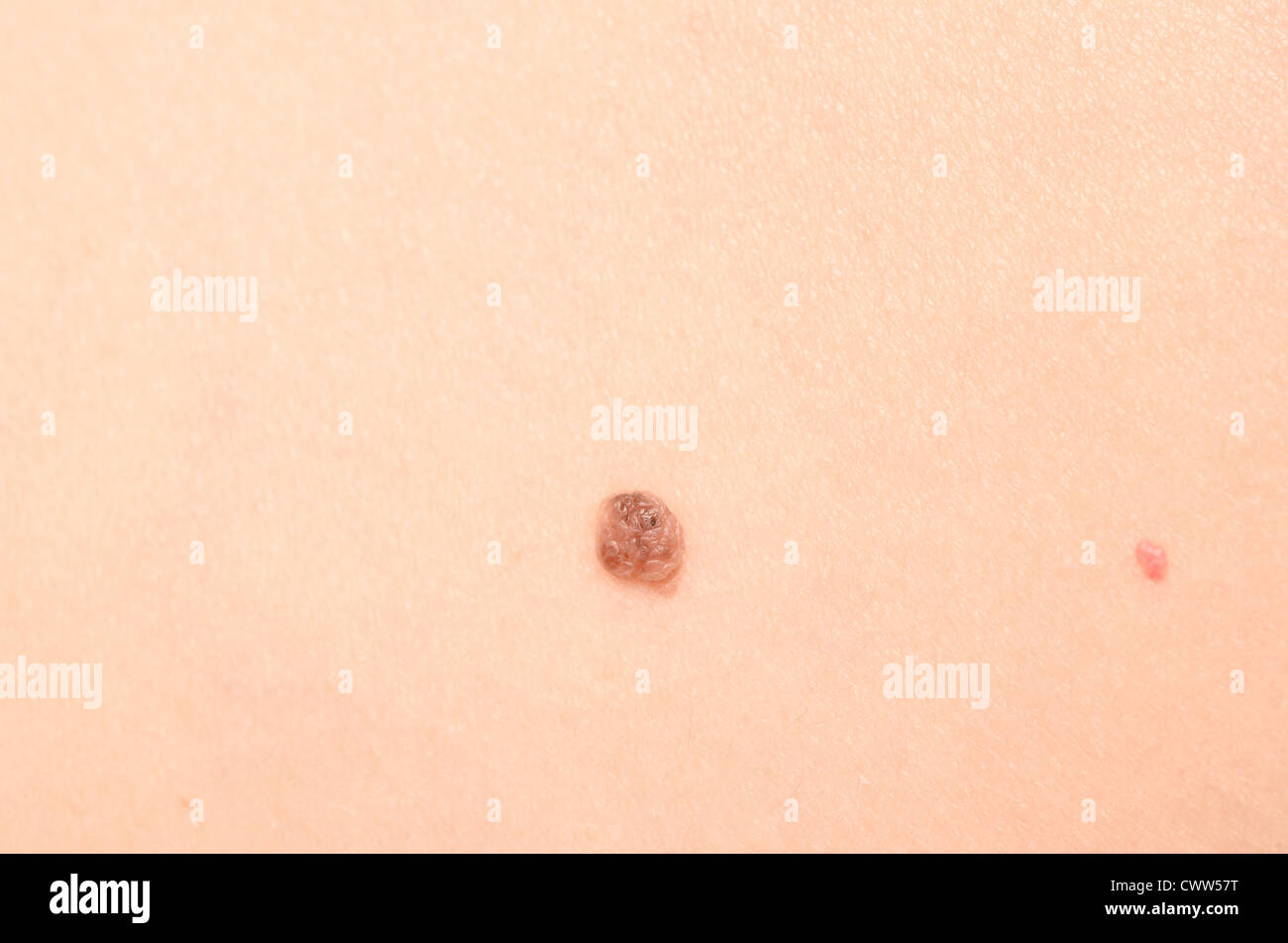 close up of mole on human skin Stock Photo - Alamy