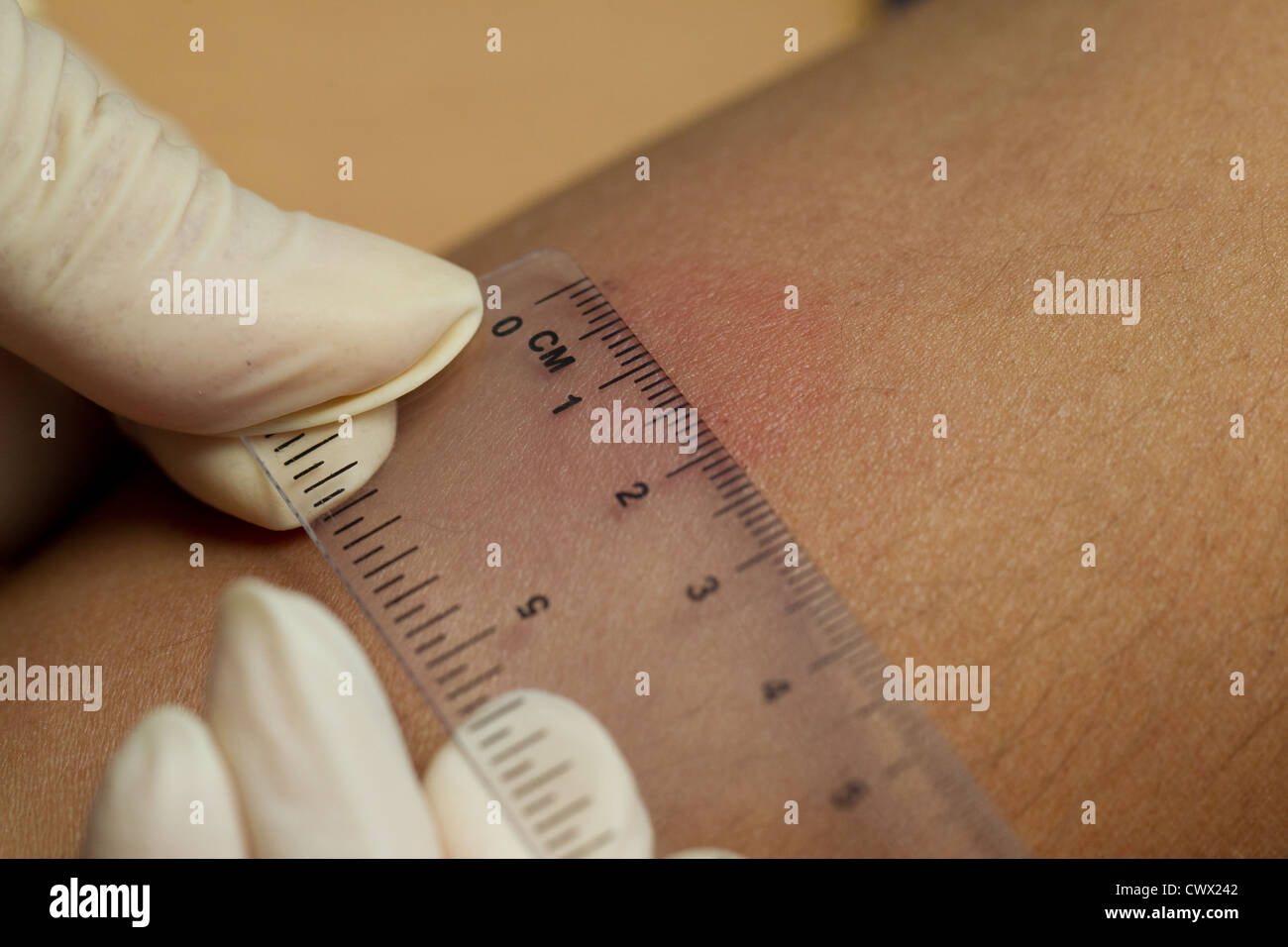 Positive test tuberculosis hi-res stock photography and images - Alamy