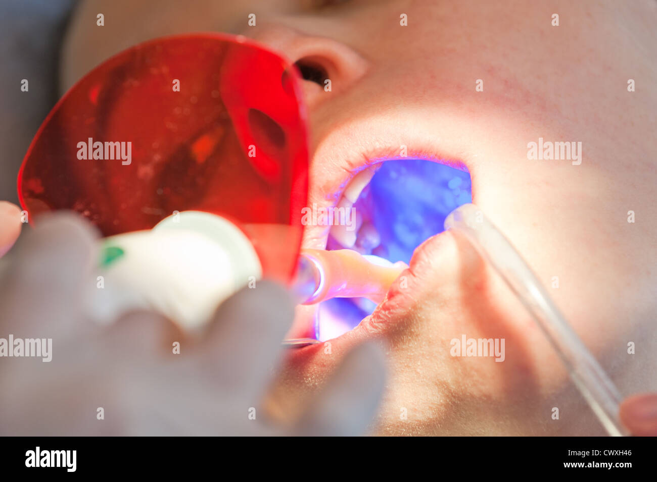 Dentinst making composite tooth fillings with UV light to the patient ...